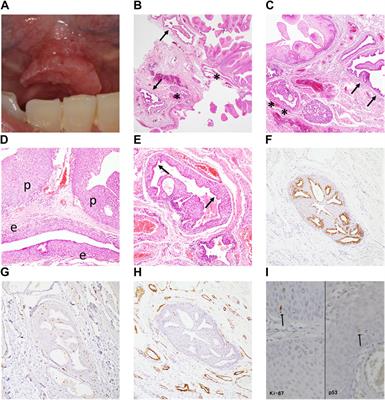 Smokers Palate Histology